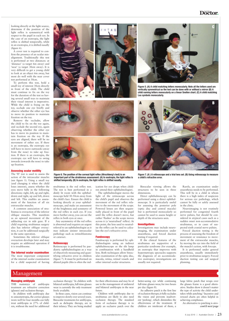 Childhood Strabismus - Sydney Ophthalmic Specialists
