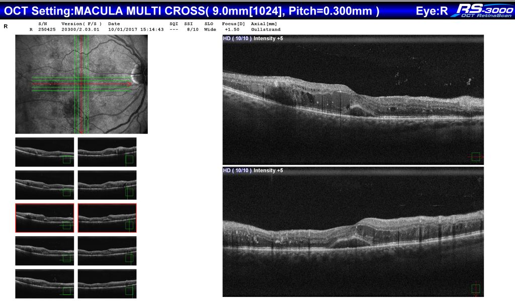 Back to Basics-Diabetic retinopathy - Sydney Ophthalmic Specialists